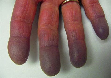 Mixed Connective Tissue Disease Mctd Musculoskeletal And Connective