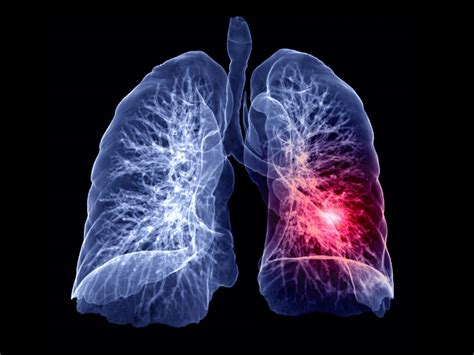 Large Pulmonary Embolism