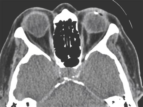 Express Shunt Glaucoma Information