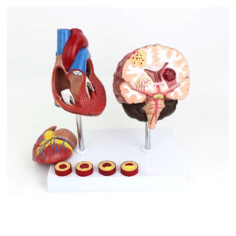 Hypertension Model
