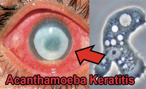 Protozoa Fungi Helminths Viruses Flashcards Quizlet