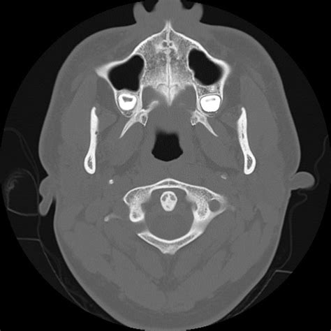 Normal Temporal Bone Ct With Annotated Images Radiopaedia 84293 99584