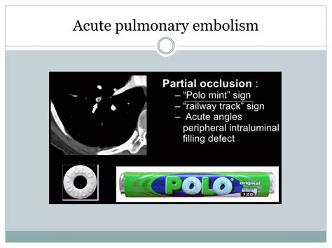 Pulmonary Embolism Radiology Pptx