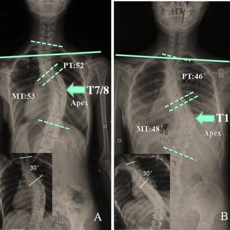 Illustrations Of Complete Proximal Thoracic Curve A Positive T1 Tilt Download Scientific