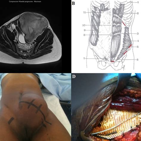 A Soft Tissue Sarcoma Infiltrating The Full Thickness Of The Abdominal Download Scientific