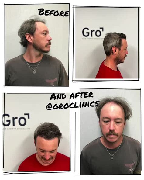 Marc Kinvig On Linkedin Hairtransplant Confidenceboost Transformationtuesday