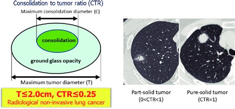 Definition Of The Consolidation To Tumor Ratio And The Typical Download Scientific Diagram