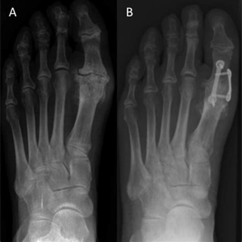 Pdf First Metatarsophalangeal Joint Arthrodesis With Two Orthogonal