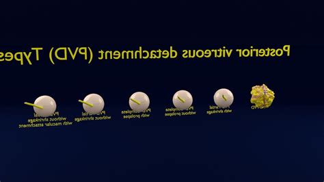 Posterior Vitreous Detachment Types Eye 3d Model Blender Market