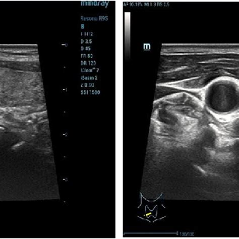The Right Thyroid Nodule With The Maximum Diameter Of 19 Mm In A