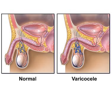 Pediatric Urology Stony Brook Medicine