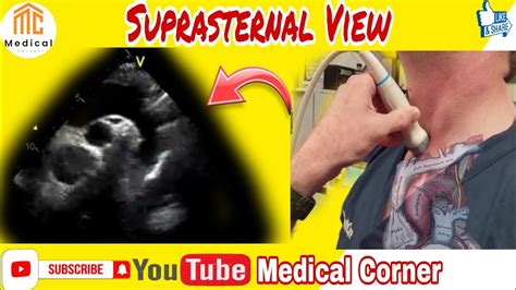 Suprasternalview Echoviews Suprasternal View Echocardiography