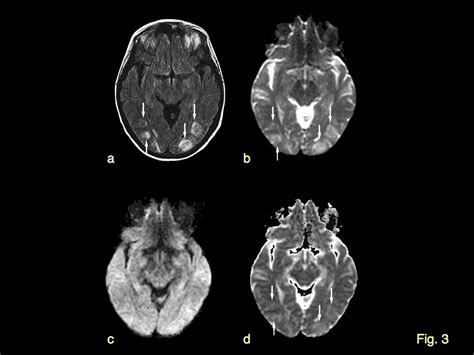 MRI BLOG Pitfalls Of Diffusion Weighted Imaging