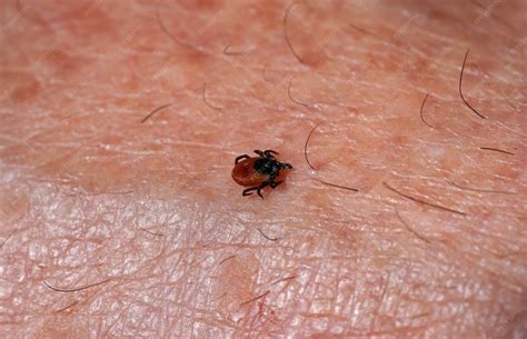 Premium Photo Small Tick Ixodes Ricinus Crawling On Human Skin