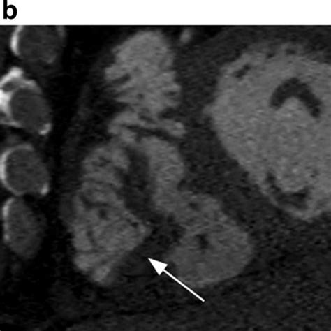 A Multiplanar Reformatting 4 Camber Computed Tomographic Image Download Scientific Diagram