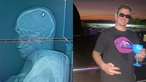 Bizarre Unaware Of Being Shot In The Head Man Parties For 4 Days With Bullet Inside Brain
