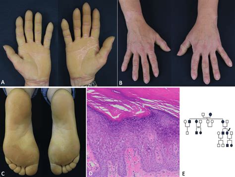 A C A Diffuse Symmetrical And Sharply Defined Hyperkeratosis Download Scientific Diagram