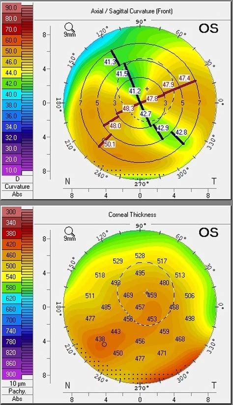 Pentacam ® Oculus Corneal Topography Of The Contralateral Eye