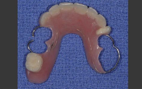 Partial Dentures Front Teeth