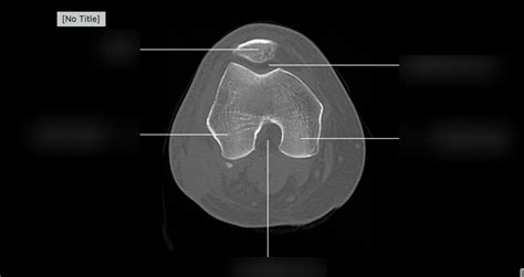 Diagram Of Ct Axial Of Knee Quizlet