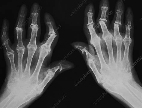 Arthritic Hands X Ray Stock Image M1100679 Science Photo Library