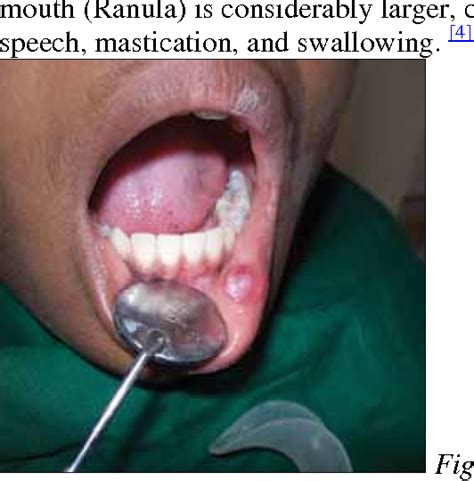 table 3 from micro marsupialization a minimally invasive technique for