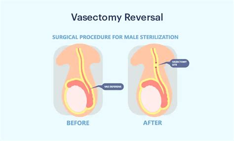 Vasectomy Reversal Procedure Recovery And Risks Vasectomy Reversal A