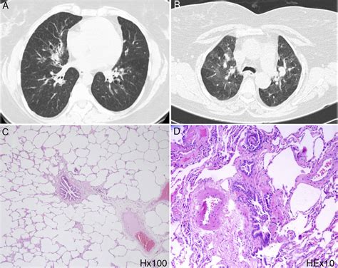 Constrictive Bronchiolitis Two Clinical Reports Pulmonology