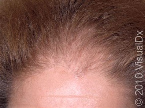 Hair Loss Female Pattern Baldness Female Pattern Alopecia Condition Treatments And Pictures