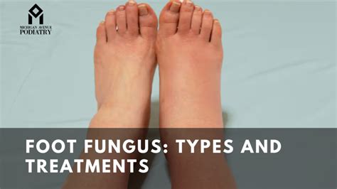A Closer Look At Endoscopic Plantar Fasciotomy Surgery