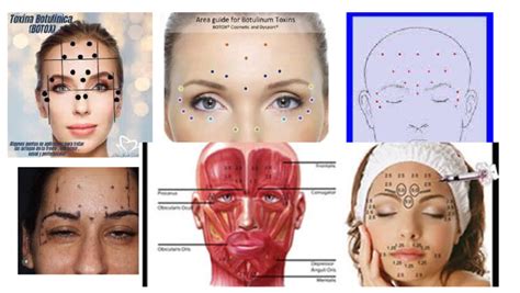 Puntos Botox Pdf