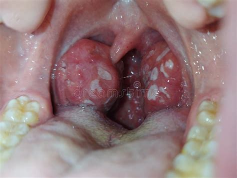 Tonsils Angina Tonsillitis Bacterial Disease Produced In The Tonsils