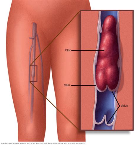 Thrombophlébite Symptômes Diagnostic Et Traitement Fmedic