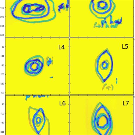 larger lesion contour analysis using matlab software comparing heat and