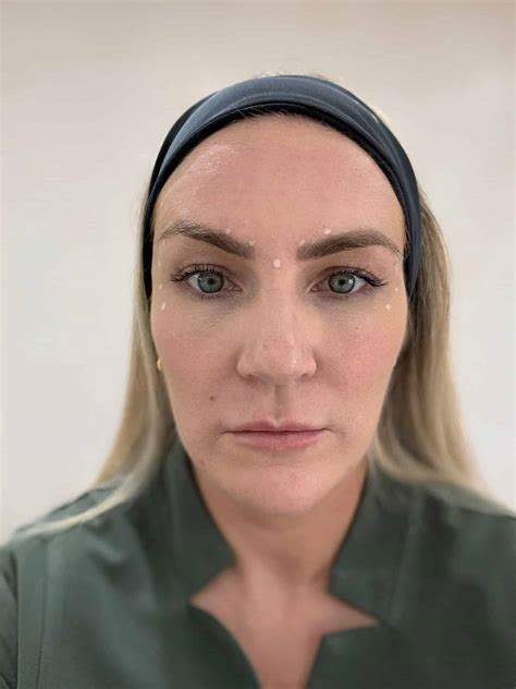 Ultimate Guide To Botox On Face Injection Areas And Effects