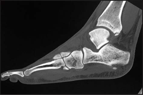 Nutcracker Fracture At Walter Pompey Blog