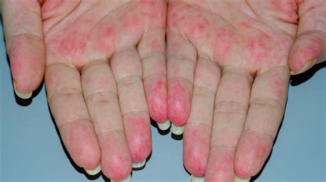 Vaskulitis Kreni Zdravo