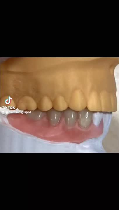 Jorge Alegre On Linkedin Great Success And Perfect Fit Flex Partials