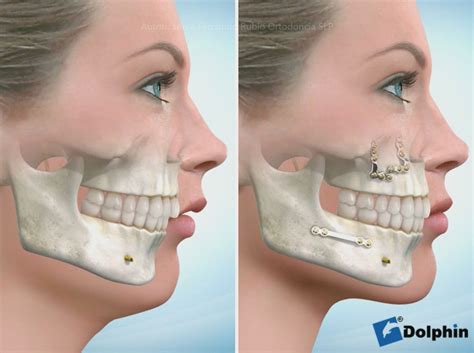 Realizacion De Cirugia Maxilofacial En Bolonia