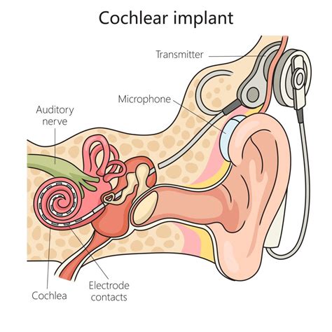 How Much Does A Cochlear Implant Surgery Cost In 2026