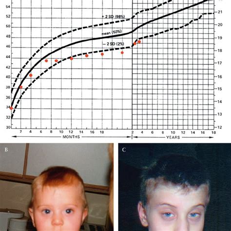 A Array Comparative Genome Hybridisation Acgh Using A Bacterial Download Scientific Diagram