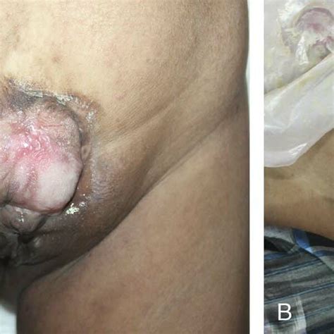 A 17 Year Old Male Patient With Exstrophy Bladder With Epispadias With