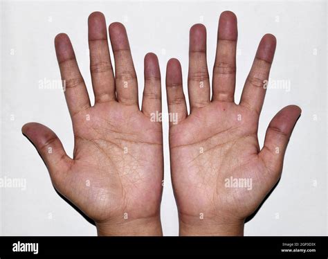 Peripheral Cyanosis In The Nail Beds