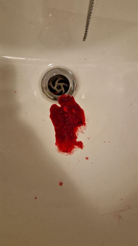 Pyoderma Gangrenosum On My Mothers Leg R Makemesuffer