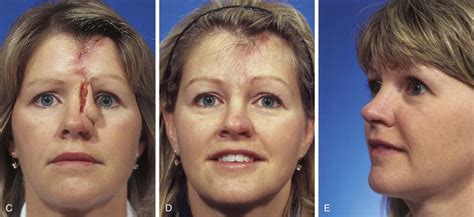 13 Interpolated Paramedian Forehead Flaps Pocket Dentistry