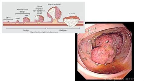 Ders Lower Gi Bleeding Pptx