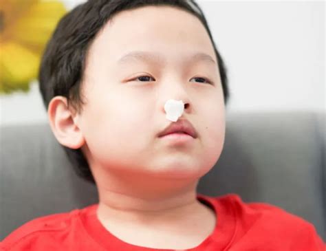 What Is A Nosebleeds Dos And Donts For Stopping And Prevention