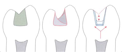 Ceramic Inlays Pocket Dentistry