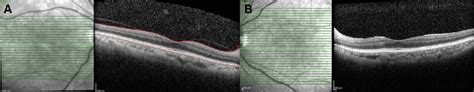 Optical Coherence Tomography Of The Macula At Presentation