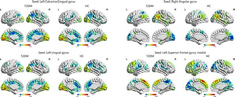 Frontiers Disrupted Balance Of Long And Short Range Functional Connectivity Density In Type 2